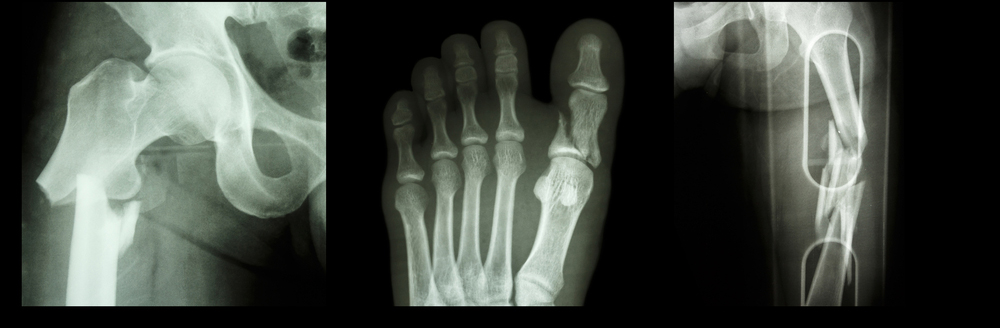 Orthopaedic Injury (25) | Home